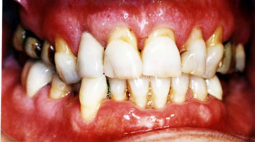 Enfermedades Periodontales; Paradontosis; Piorrea Alveolar; Parodontosis